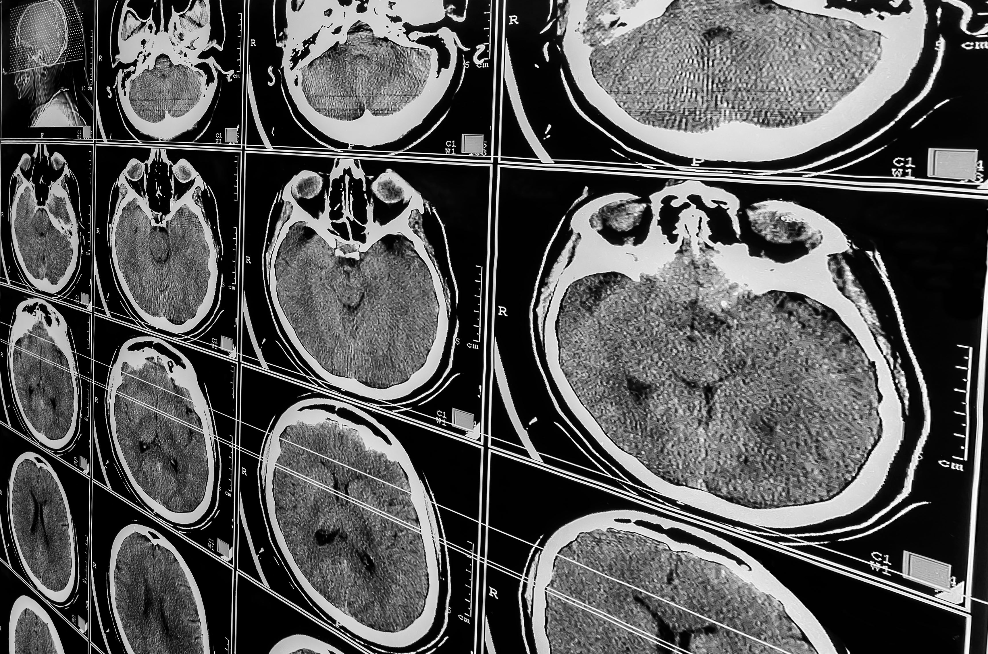 What is a Mild Traumatic Brain Injury? | Gaddis, Herd, Craw & Adams, P.C.